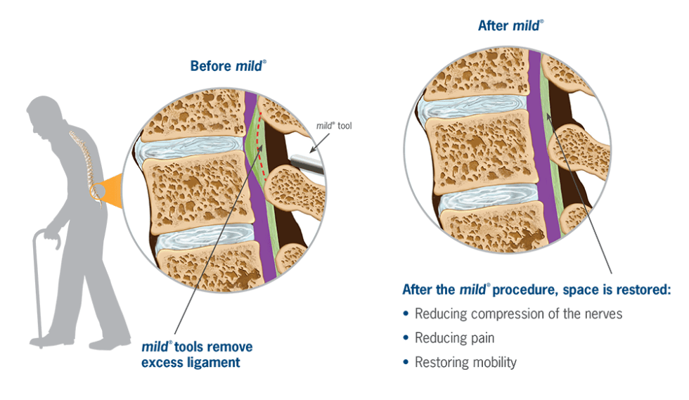 mild® - Columbia Pain Management, P.C.
